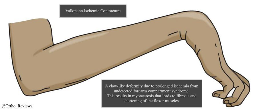 Volkmanns Ischemic Contracture
