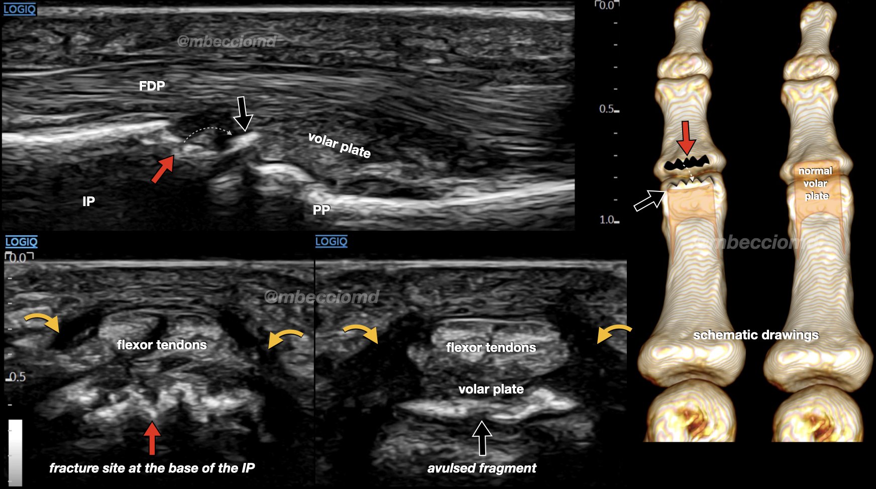 Volar Plate Anatomy PIPJ Dislocations | The Bone School