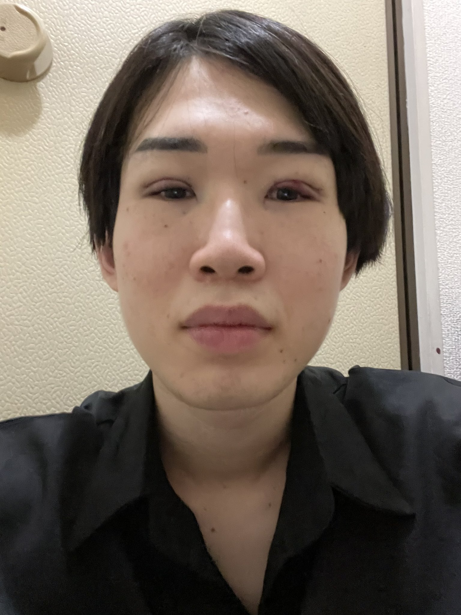 はくべえ🌨 On Twitter 眼瞼下垂保険適応手術受けてきました Sef3dtg6vi Twitter