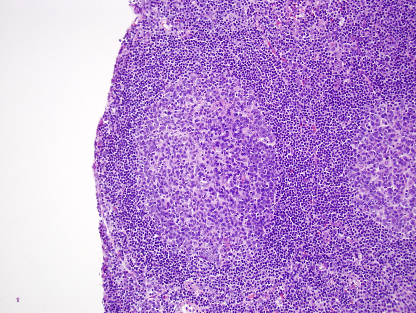 Germinal Center Lymph Node