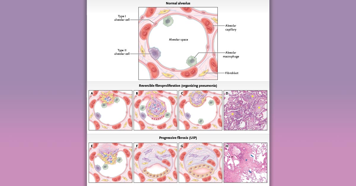 NEJM on Twitter: "Cryptogenic organizing pneumonia (formerly bronchiolitis obliterans organizing ...