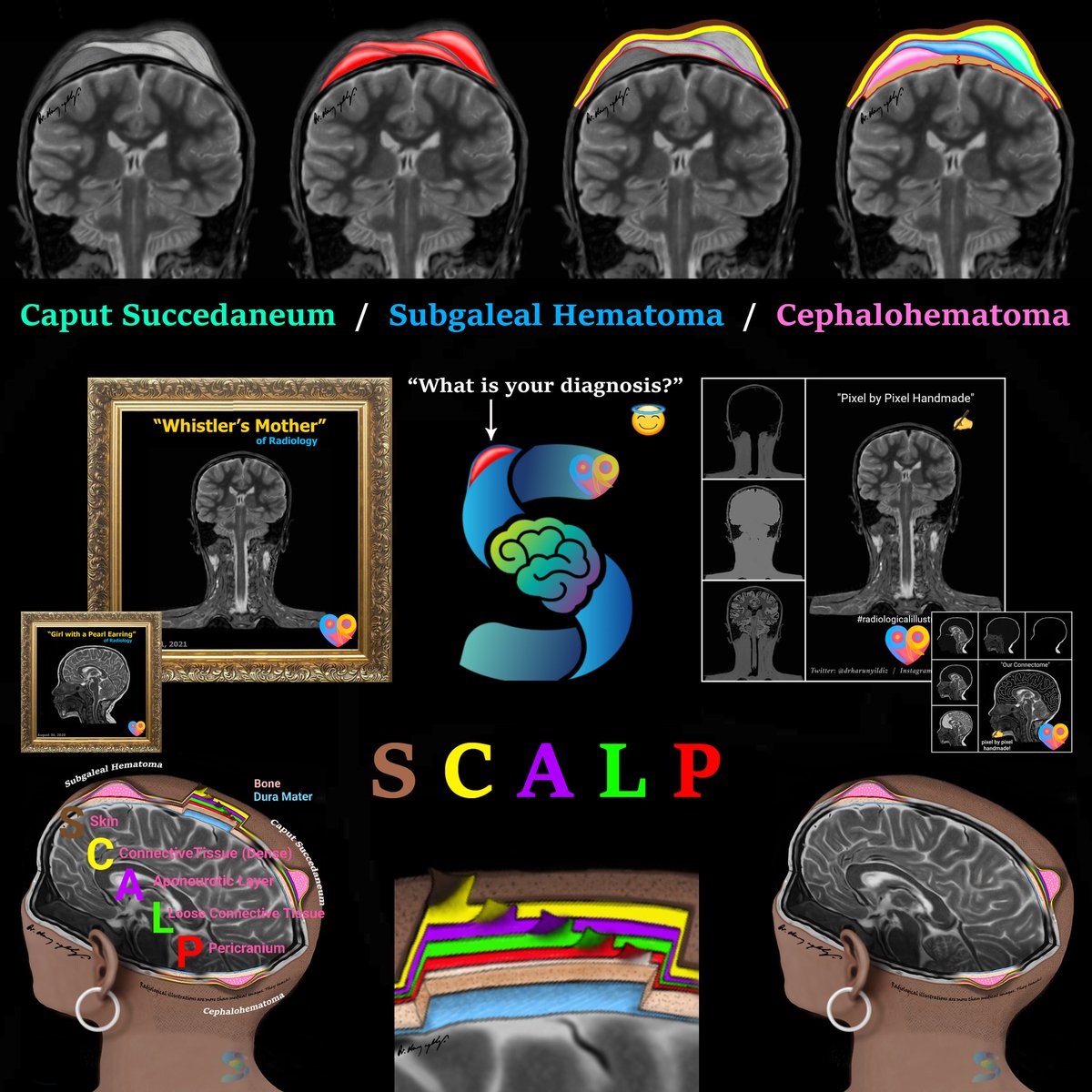 Caput Succedaneum Vs Cephalohematoma