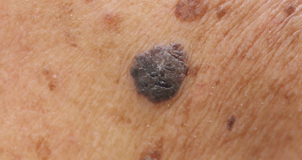 Cancerous Skin Tags