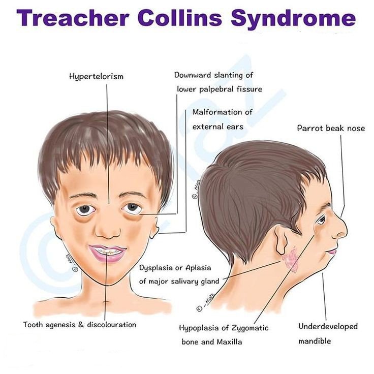 Treacher Collins Syndrome