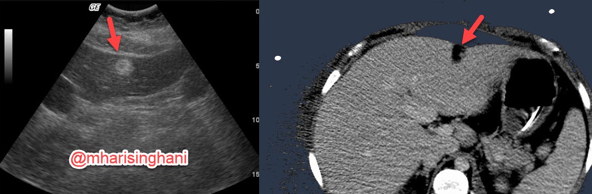 Falciform Ligament Ultrasound