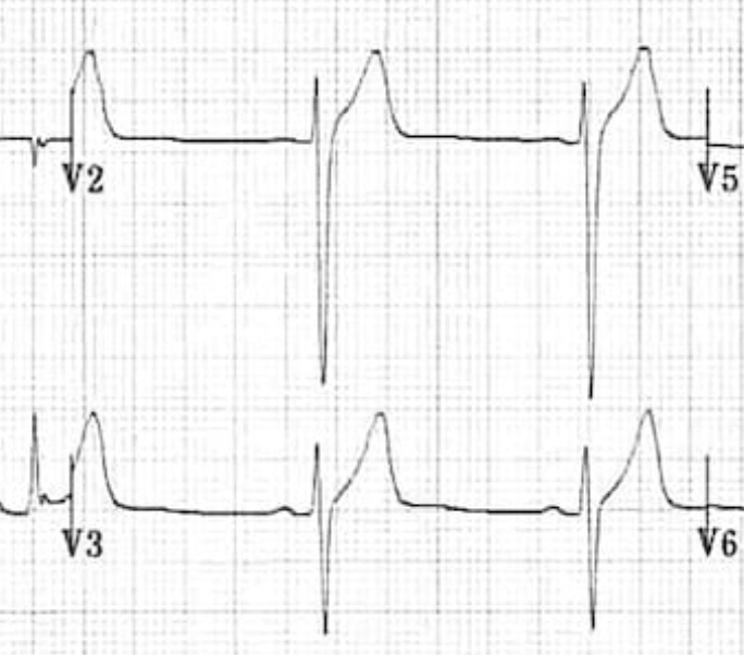 Benign Early Repolarization