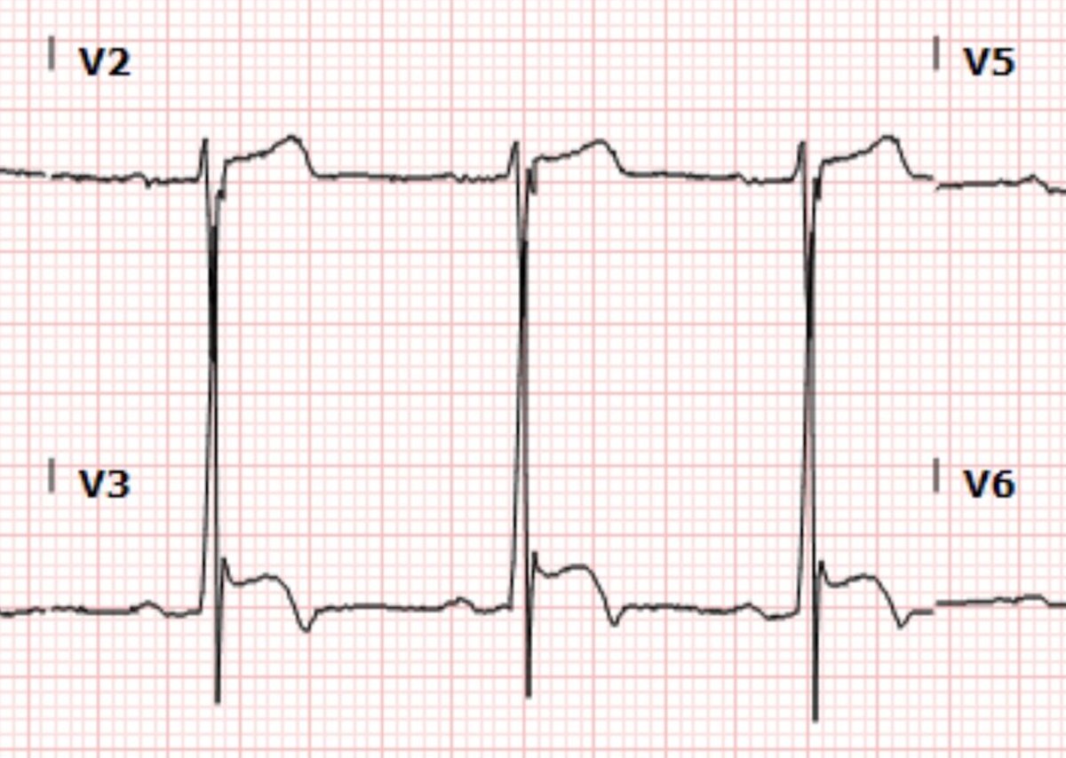 2 early repolarization variants (funky ST-T segments) to learn & save ...