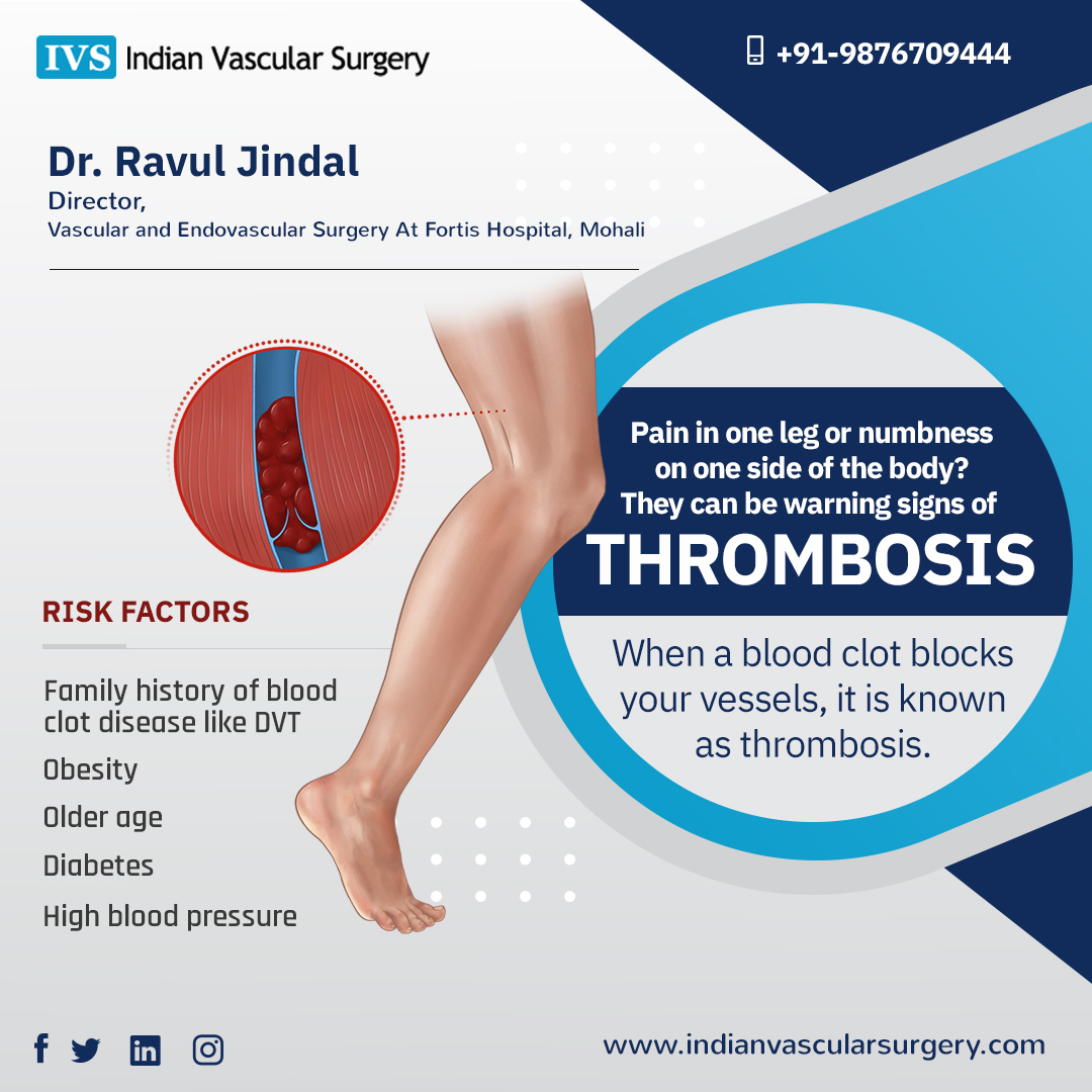 Arterial Thrombosis Vs Venous Thrombosis
