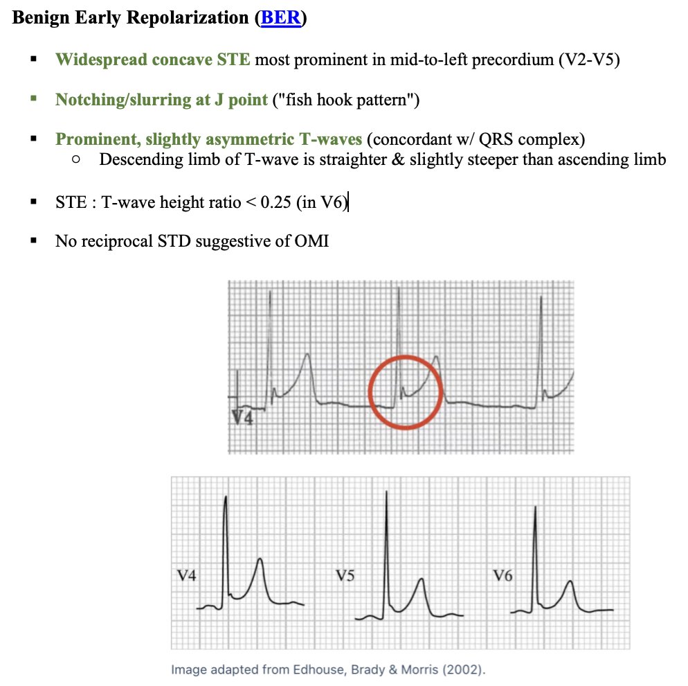 Early Repolarization