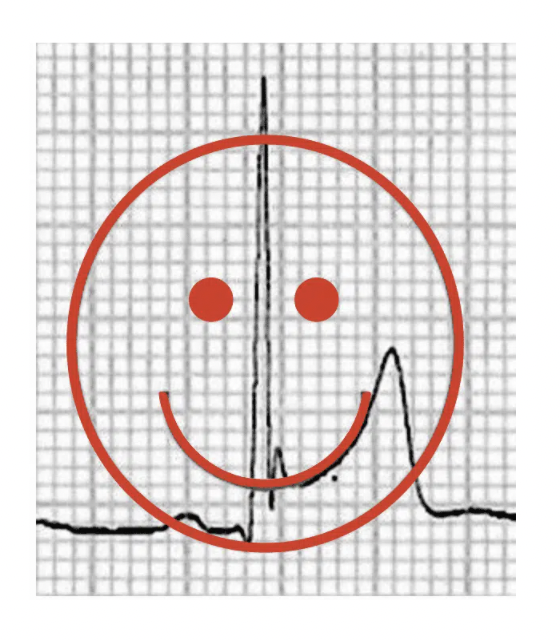 2 early repolarization variants (funky ST-T segments) to learn & save ...