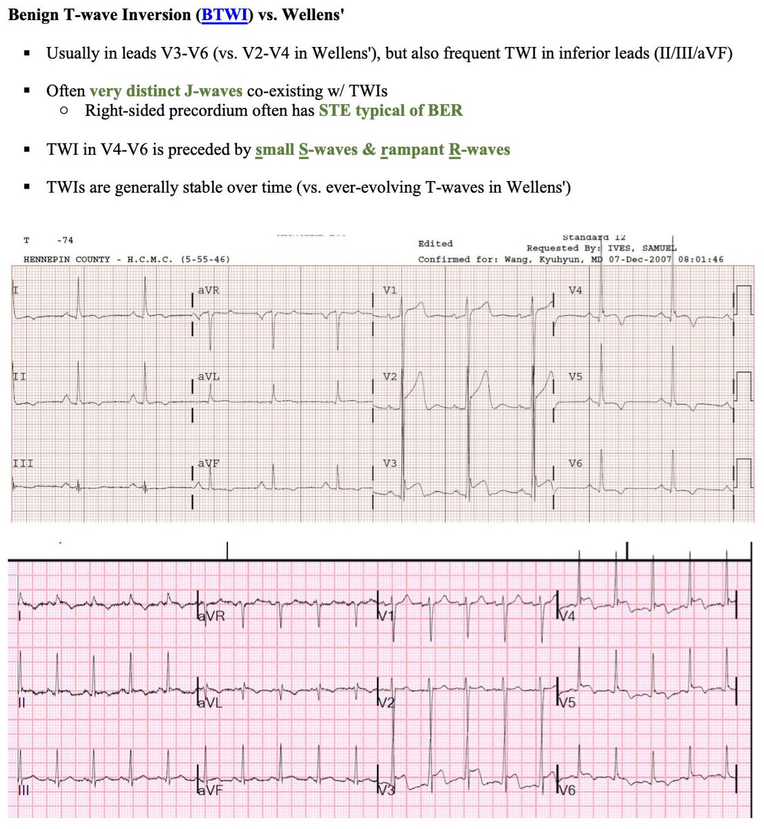 2 early repolarization variants (funky ST-T segments) to learn & save! ♥️ Benign early ...