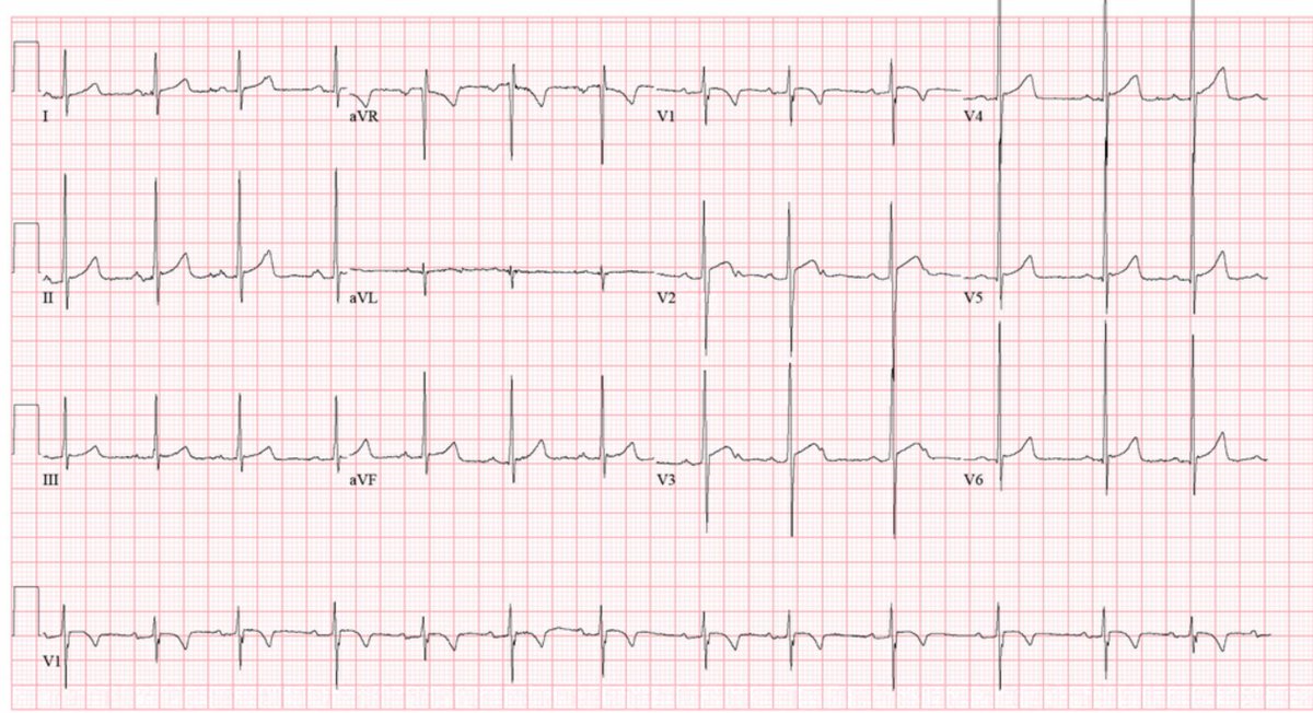 2 early repolarization variants (funky ST-T segments) to learn & save ...