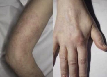 Images of Infectious Diseases 52F. SLE Rx cyclophosphamide ...