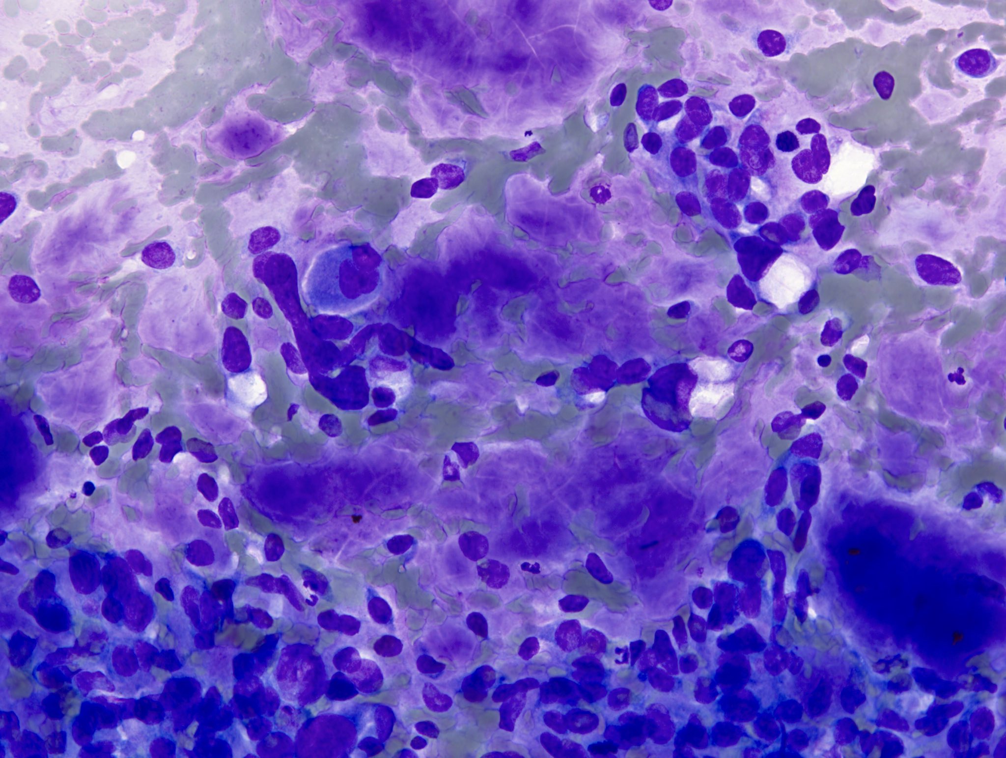Medullary Carcinoma Amyloid Metastatic Medullary Carcinoma Of The