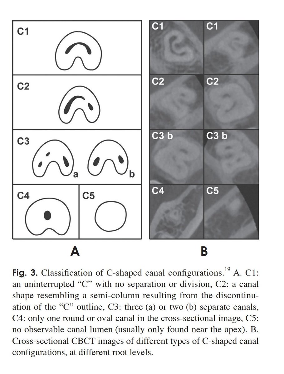 C-Shaped canal #Dental_by_Hadeel - Thread from هديل 🕊 @Hadeel7m - Rattibha