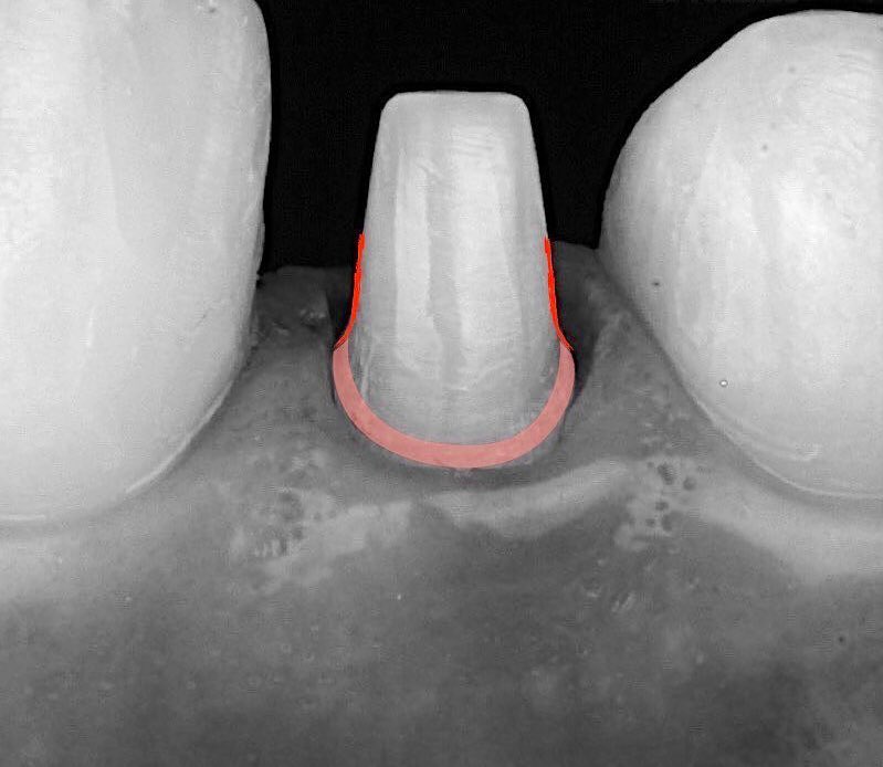 First of all, and before the start of preparing the tooth, you must ...