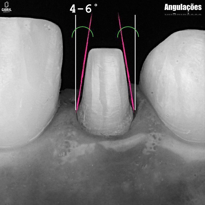 First of all, and before the start of preparing the tooth, you must ...