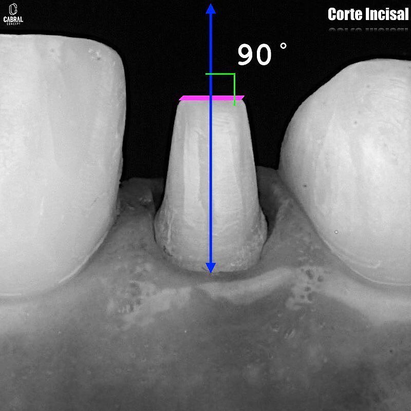 First of all, and before the start of preparing the tooth, you must ...