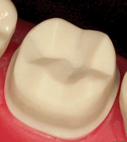 First of all, and before the start of preparing the tooth, you must ...