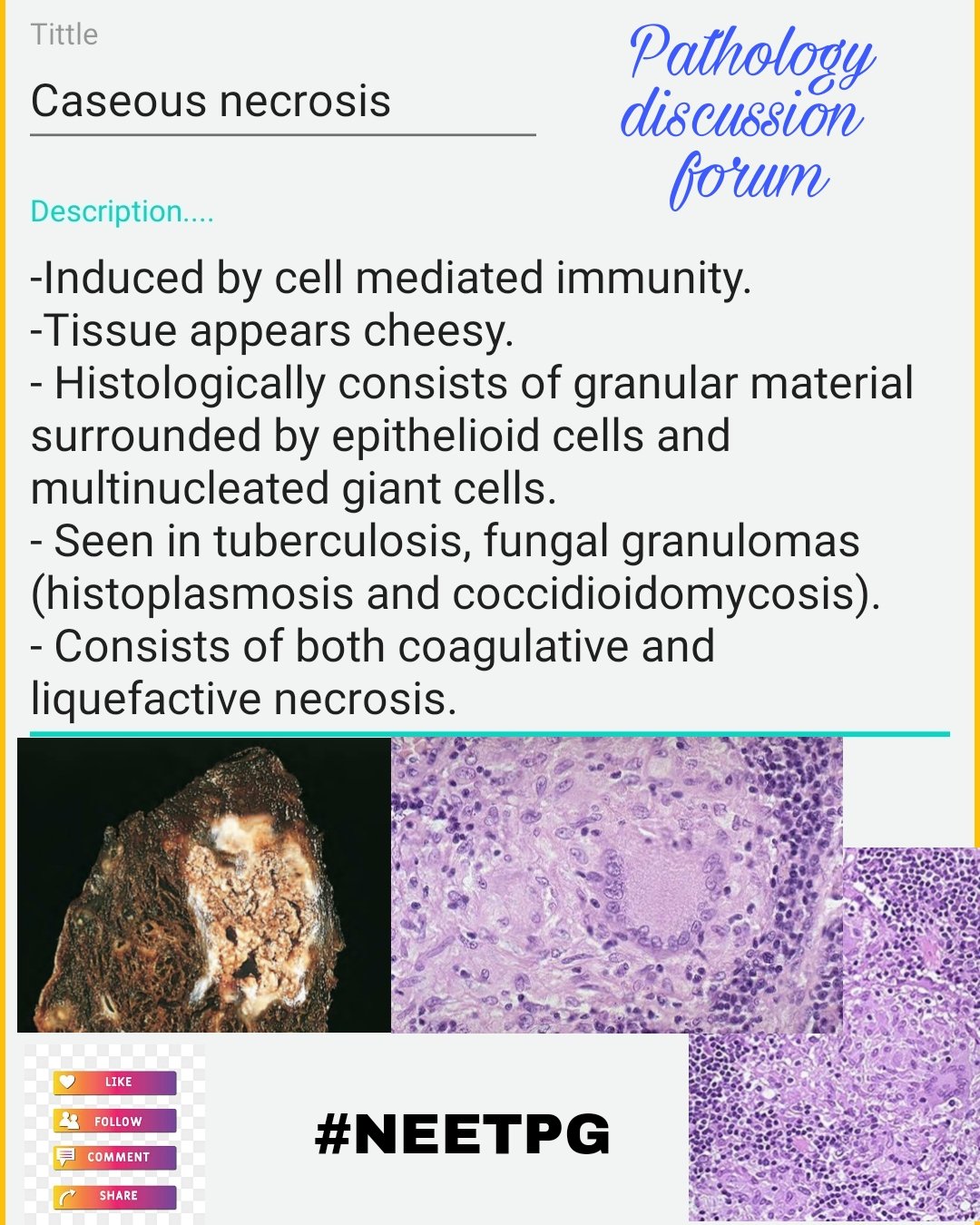 Caseous Necrosis Histology Caseous Necrosis Histology