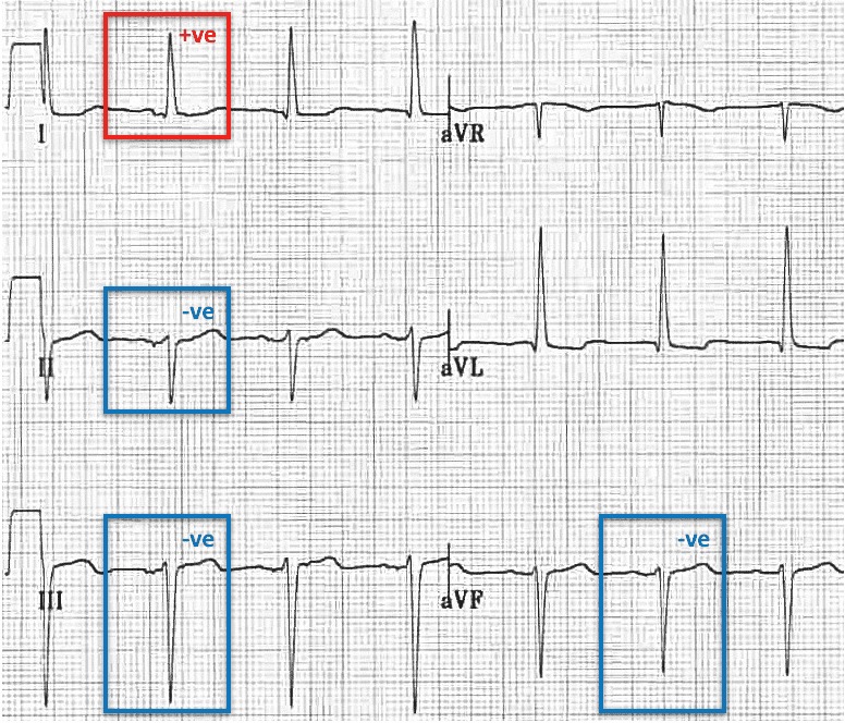 كيف تقرأ تخطيط القلب "ECG" وانت بالراوندز؟ ثريد لنتجنب معا الصفنة ...