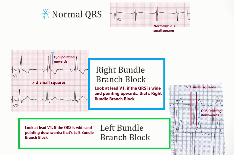Narrow Qrs Complex