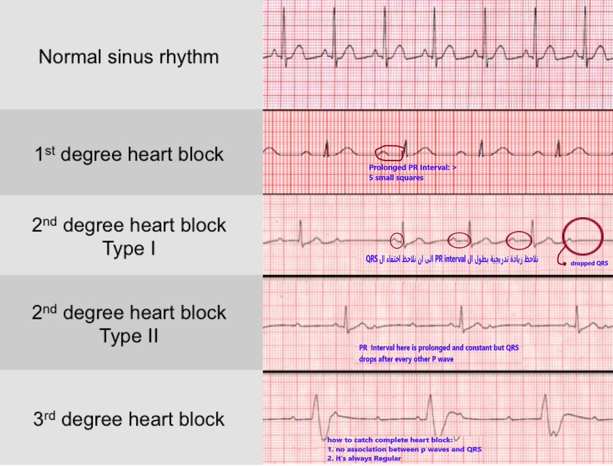 كيف تقرأ تخطيط القلب "ECG" وانت بالراوندز؟ ثريد لنتجنب معا الصفنة ...