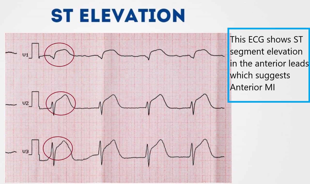 Diagram Of St Elevation