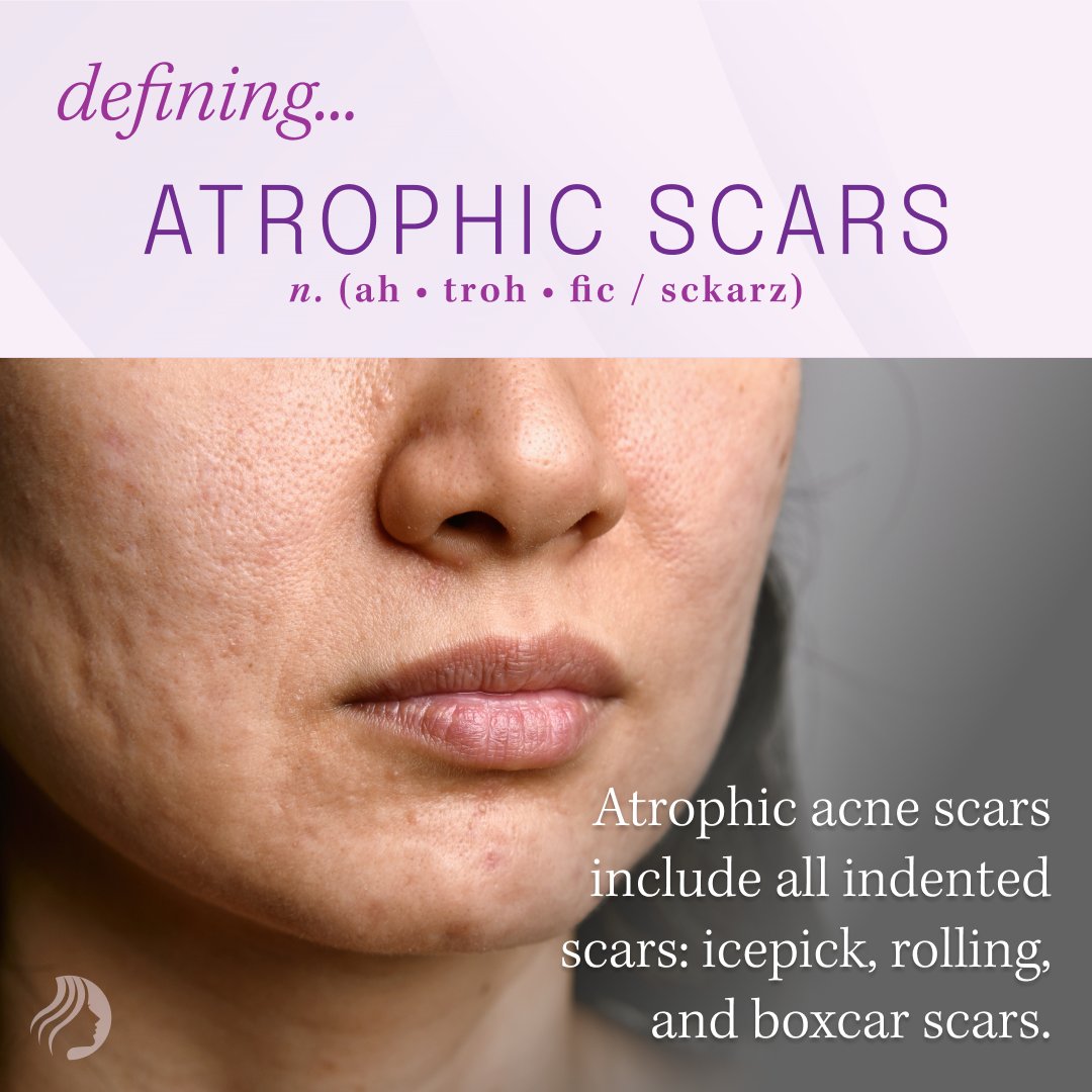 Atrophic Acne Scars