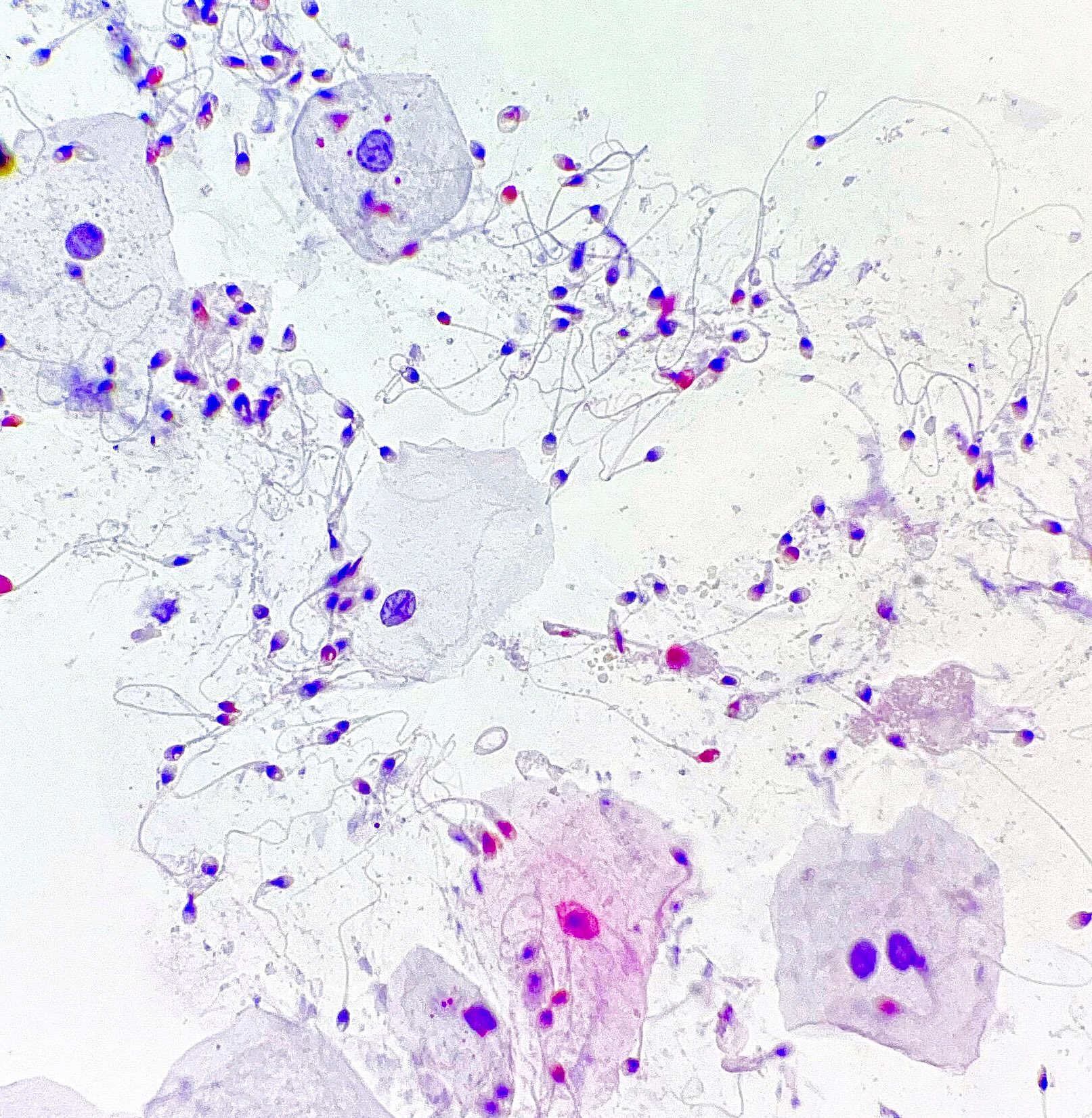Spermatozoa In Urine
