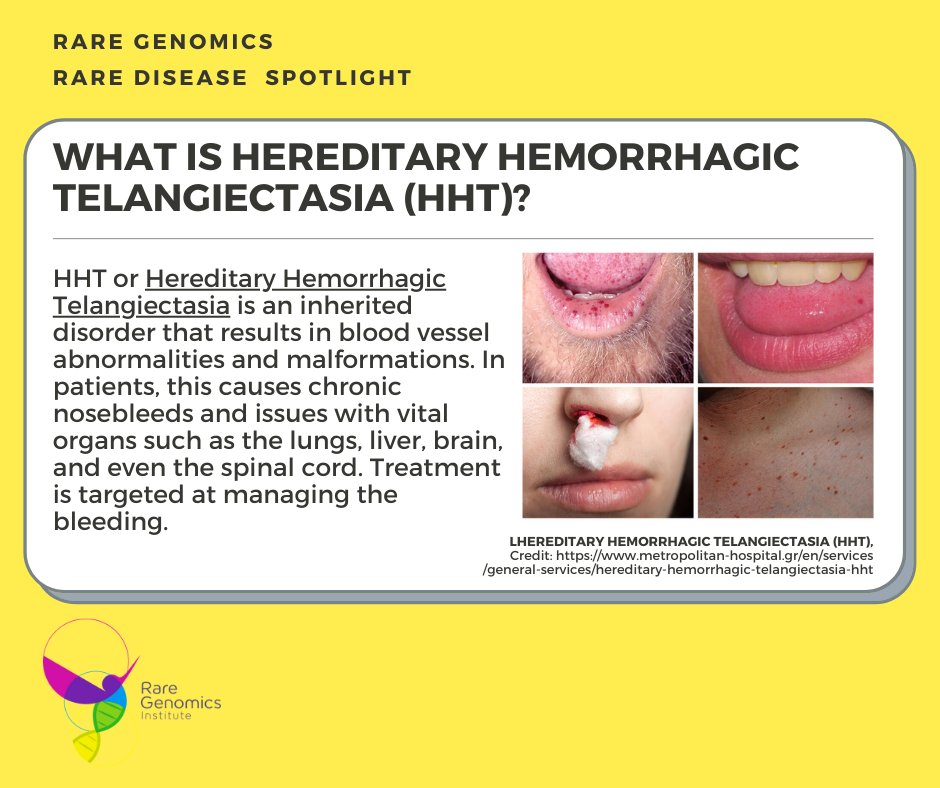 Hereditary Hemorrhagic Telangiectasia Brain