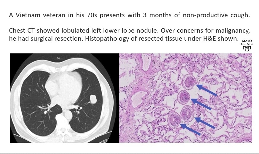 Images of Infectious Diseases 70M. Vietnam veteran. Prostate ca. CC: 3 ...