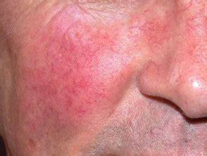 Alcohol Poisoning Rash On Face