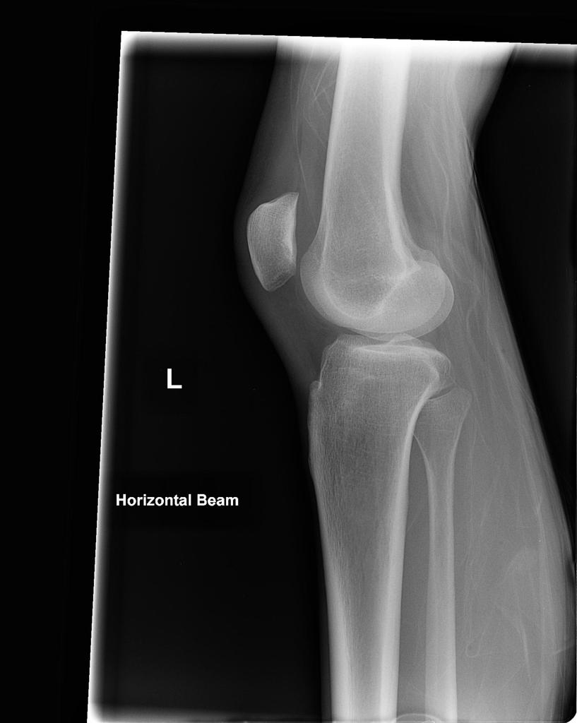 Knee Patellar Dislocation X Ray
