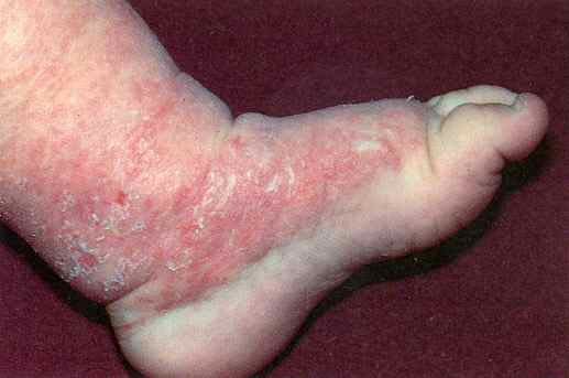 Lichenification Skin