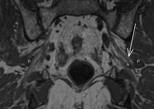 Piriformis Syndrome Mri