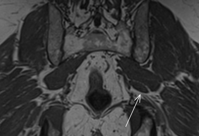 Piriformis Syndrome Mri