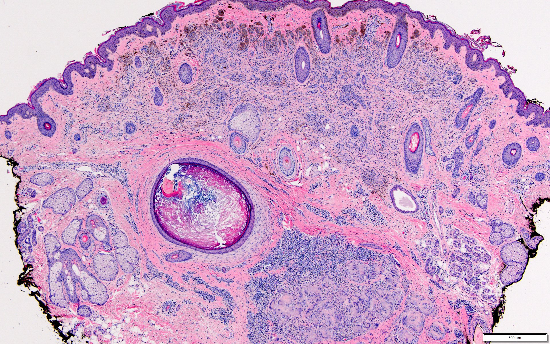 Benign Nevus Histology