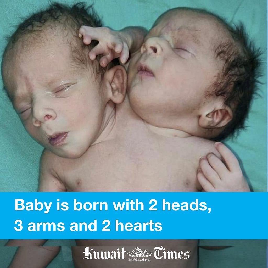 Human With Two Heads