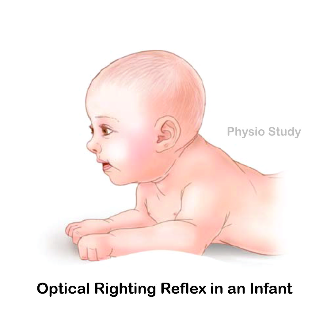 Optical Righting Reflex Infants