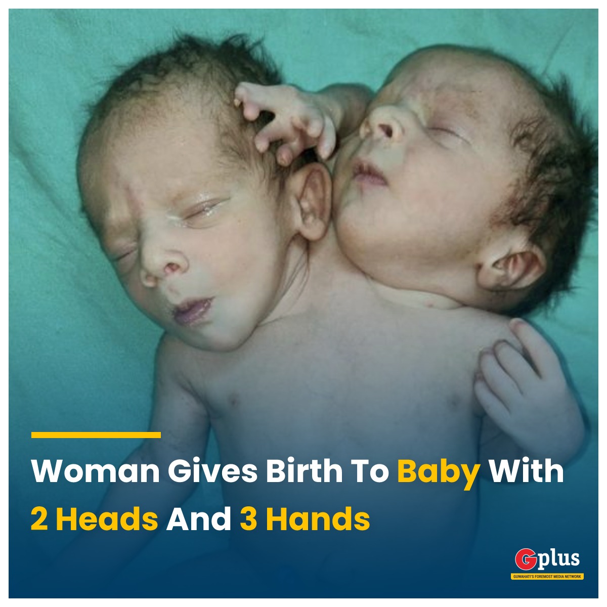 2 Headed Baby