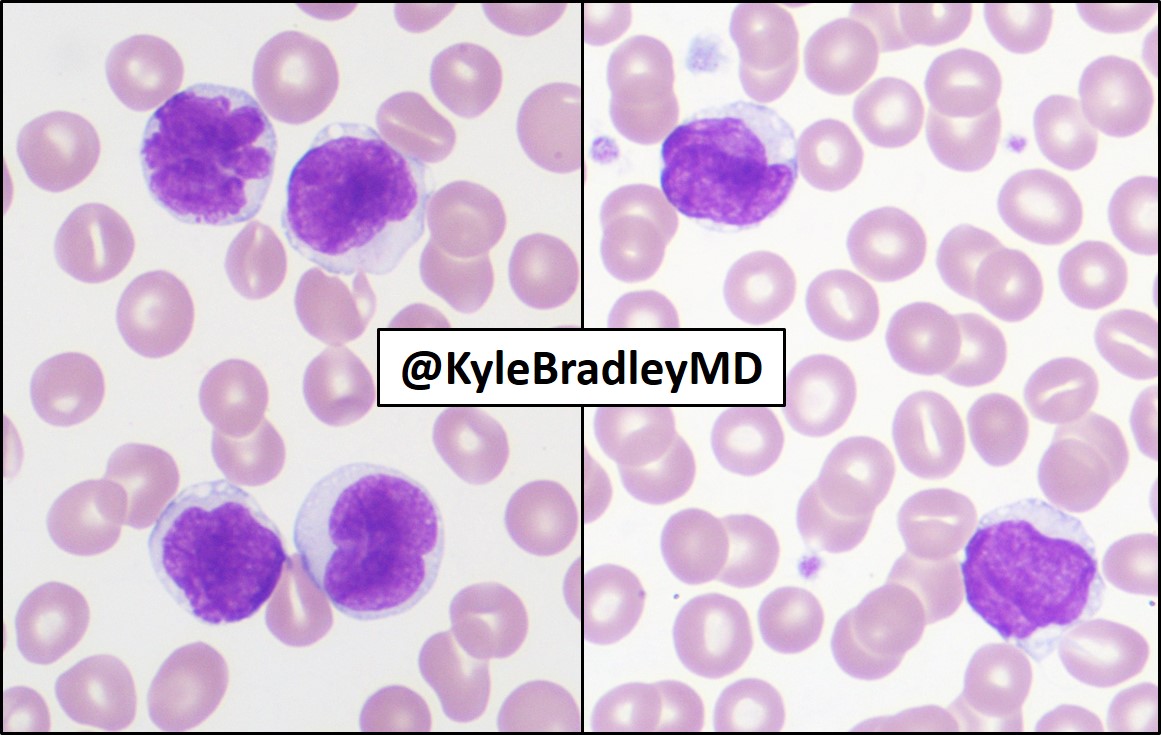 Atypical Lymphocyte