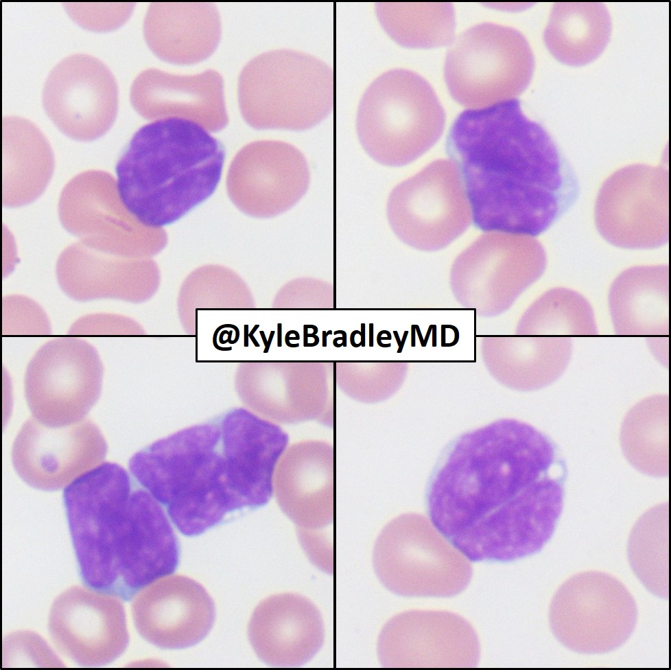 What Are Atypical Lymphocytes
