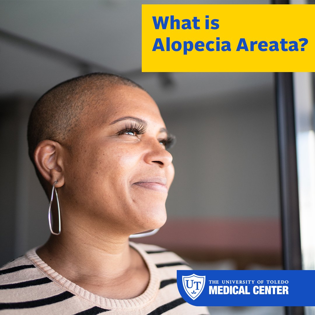 Alopecia Universalis Woman