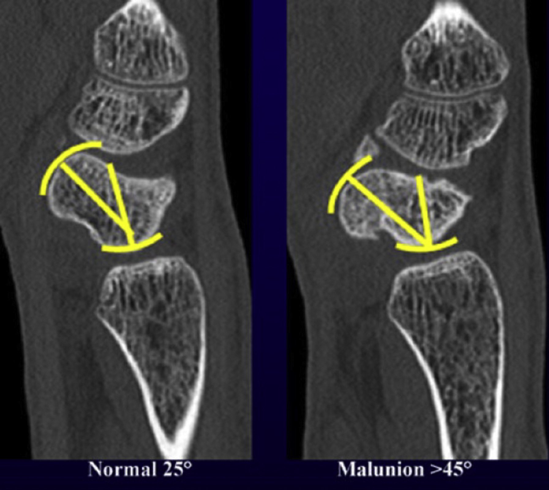 Scaphoid X Ray Angle