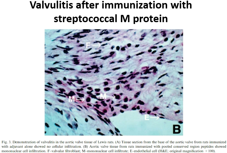 1/🧵 Ever wonder why rheumatic heart disease almost always damages heart ...