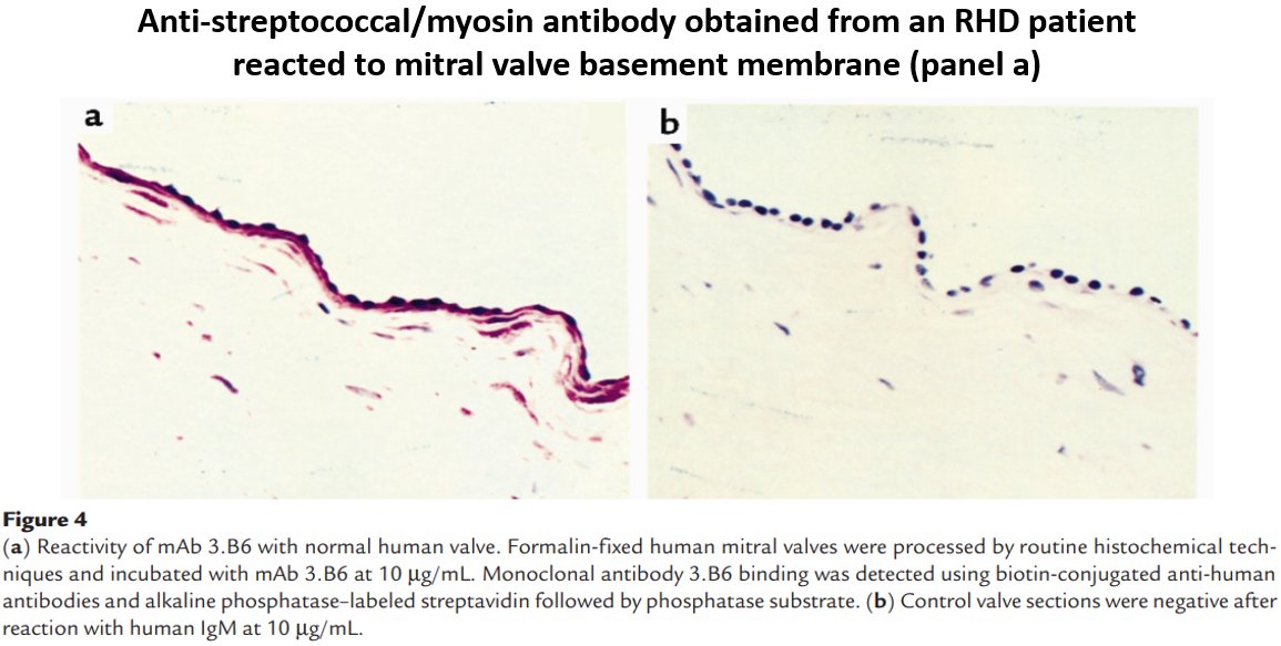 1/🧵 Ever wonder why rheumatic heart disease almost always damages heart ...
