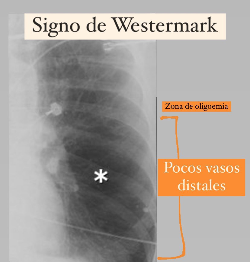 TODO paciente con dolor torácico en urgencias en quién sospechemos ...