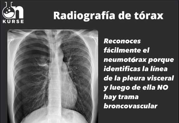 TODO paciente con dolor torácico en urgencias en quién sospechemos ...