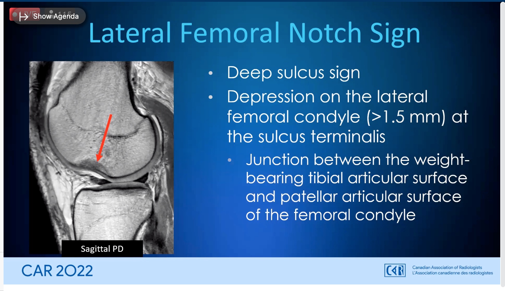 Sulcus Terminalis Lateral Femoral Condyle